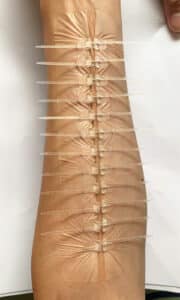 Longmed Medical ZipStitch Wound Closure Device Bandage