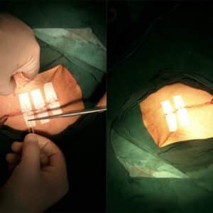 Wound Healing Zip Stitch Wound Closure Device Steri Strip